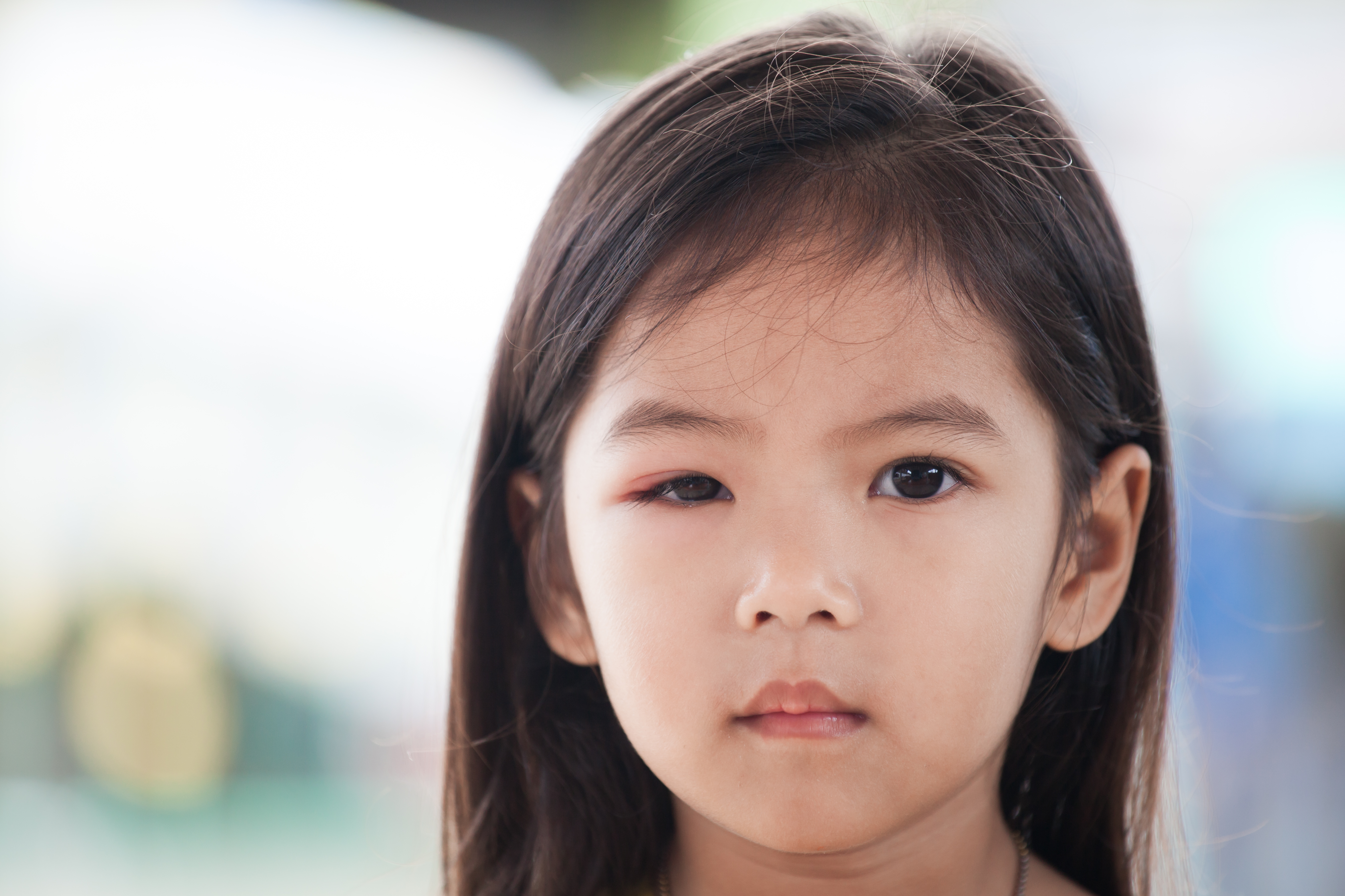 Periorbital Cellulitis Contagious